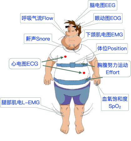 多导睡眠图(Polysomnogram, PSG) - 杰富瑞医疗